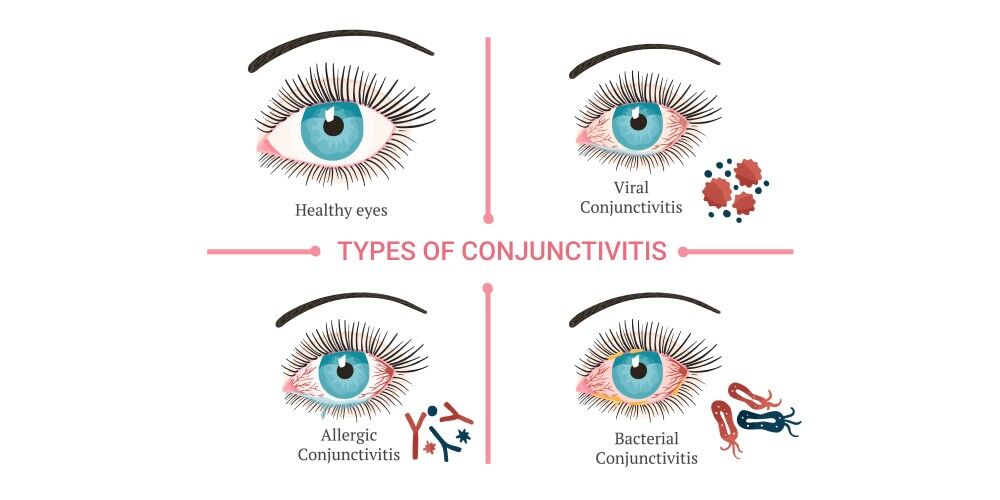 allergic conjunctivitis complications